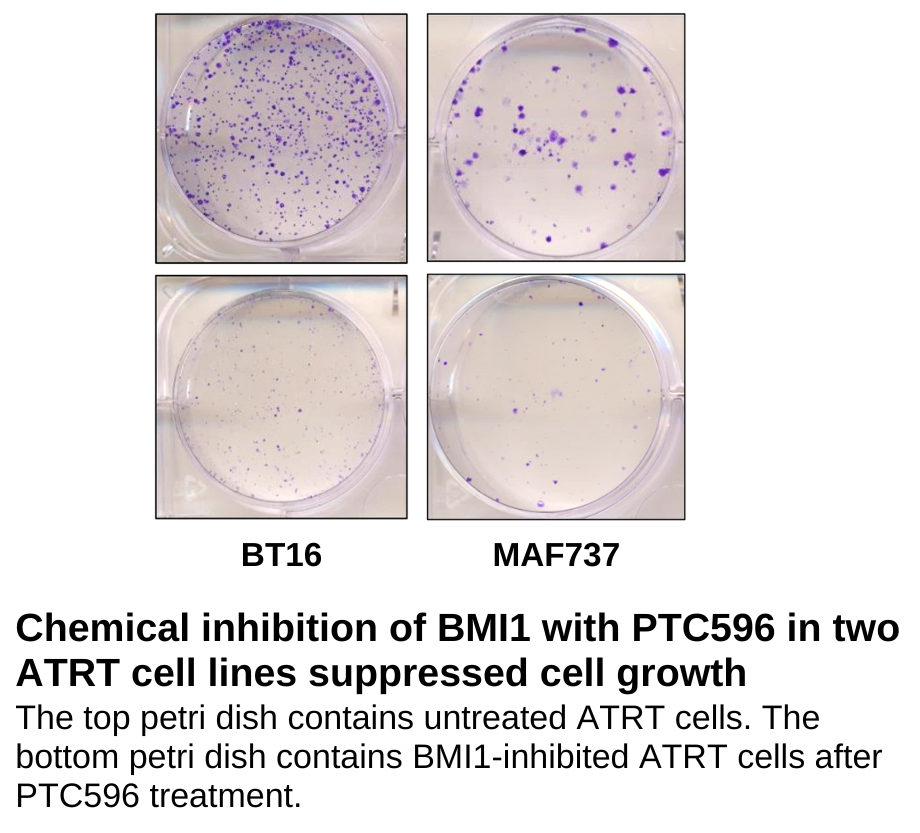 The search for effective treatment for kids with atypical teratoid ...